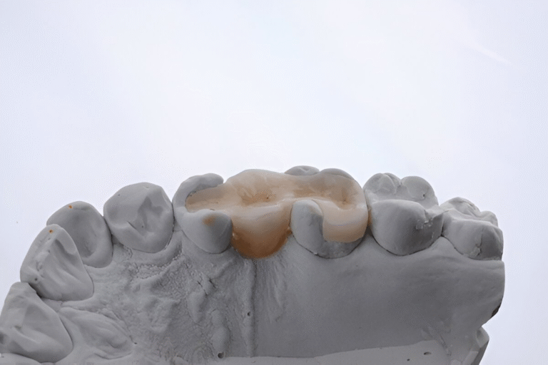 Dental Inlays and Onlays in Wilmington | Dental Inlays and Onlays Near Me